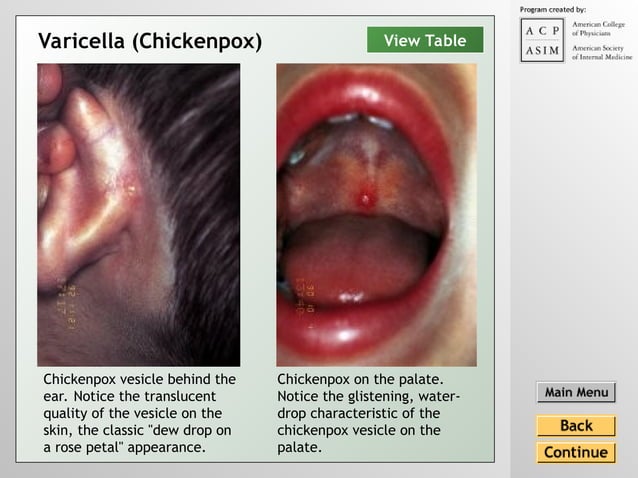 smallpox.ppt Smallpox ppt smallpox ppt small pox | PPT