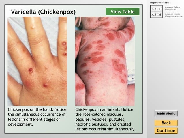 Smallpox Ppt Smallpox Ppt Smallpox Ppt Small Pox Ppt