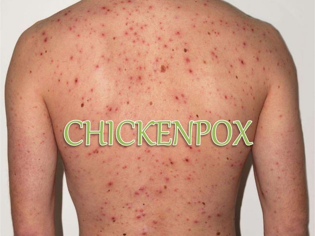 Smallpox& chiken pox | PPTX
