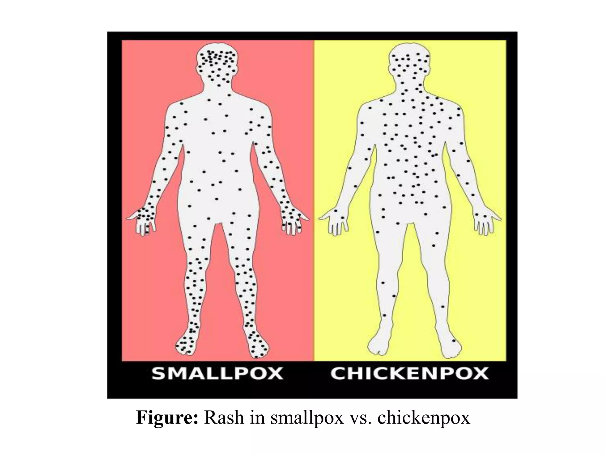 Smallpox disease | PPTX