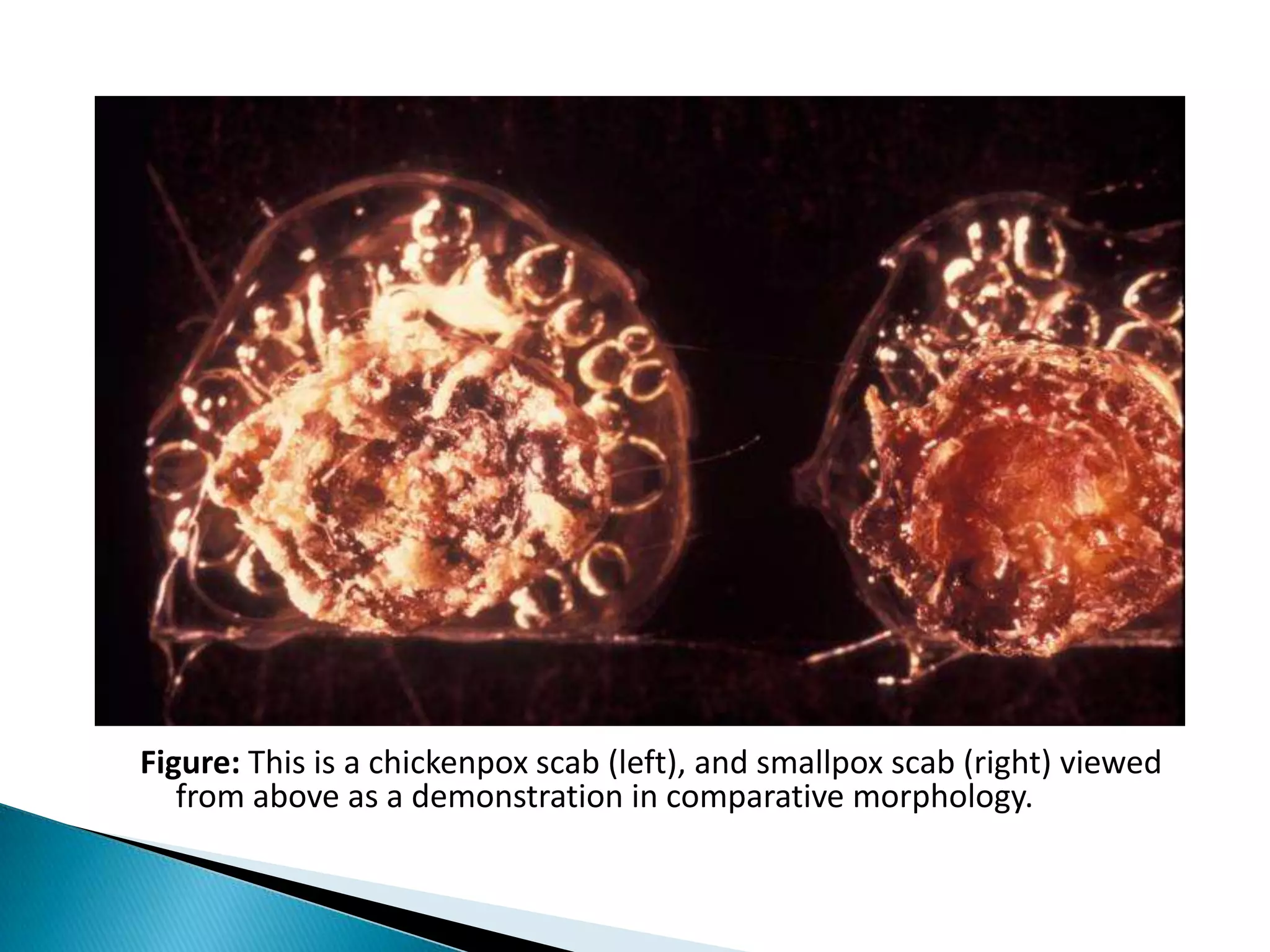 Smallpox disease | PPTX
