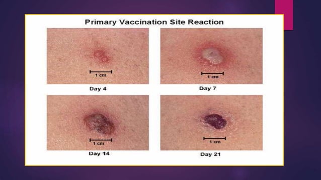SMALL POX; Variola virus@variola major and variola minor.pptx