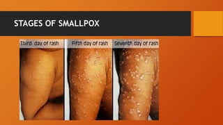 SMALL POX new.pptx