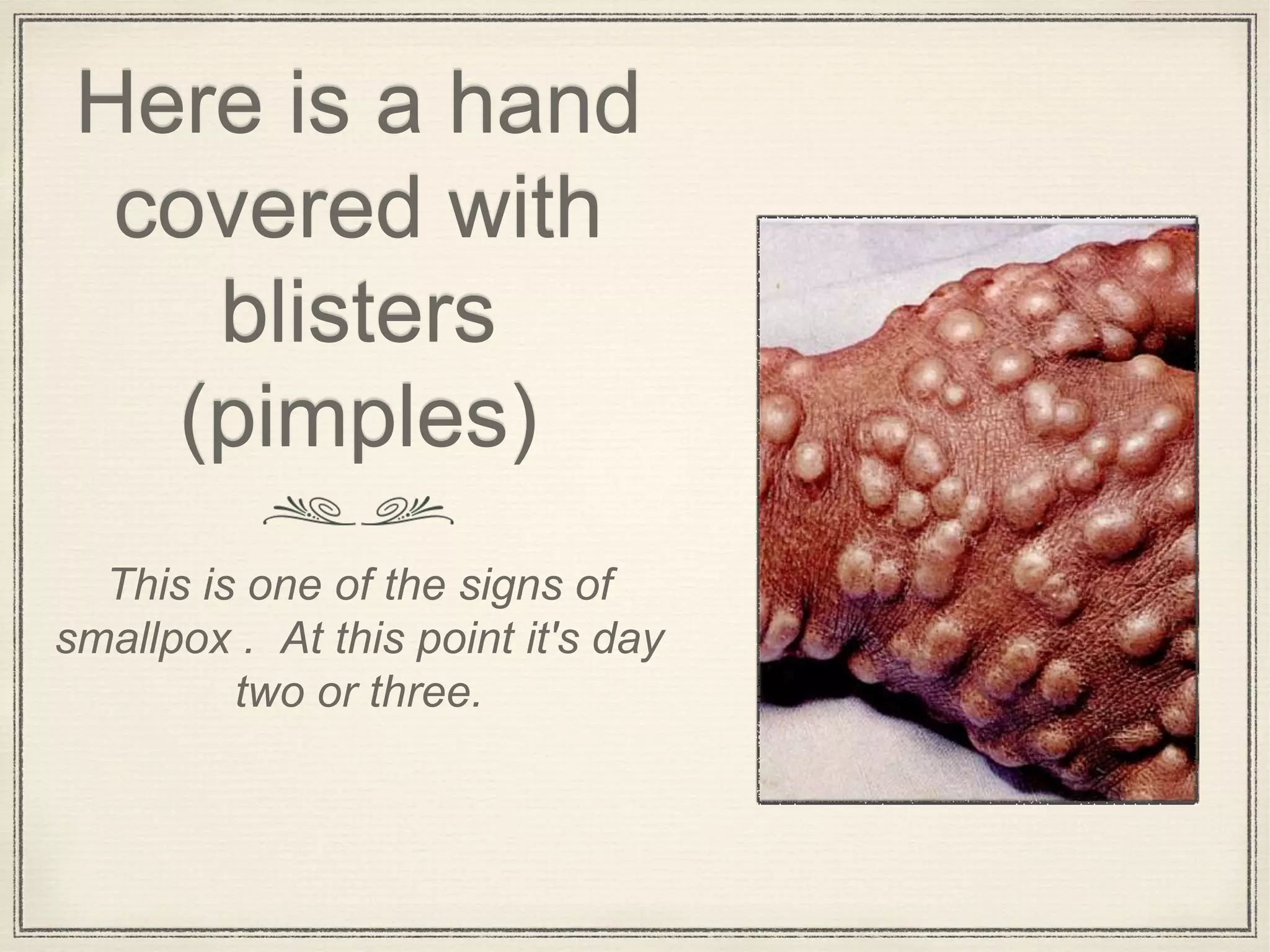 Smallpox slideshow | PPTX