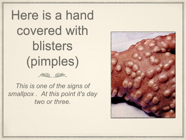 Smallpox slideshow | PPT