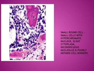 SMALL ROUND CELL TUMOR -1 powerpoint.ppt
