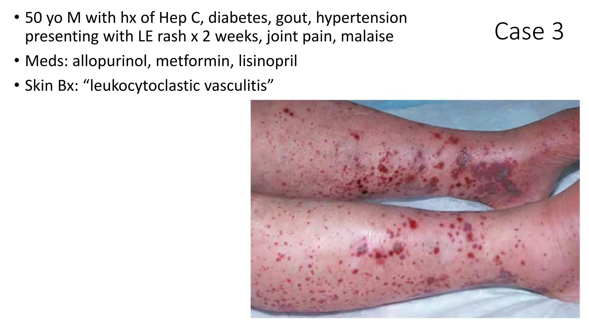 Small vessel vasculitis - Bauer | PPTX