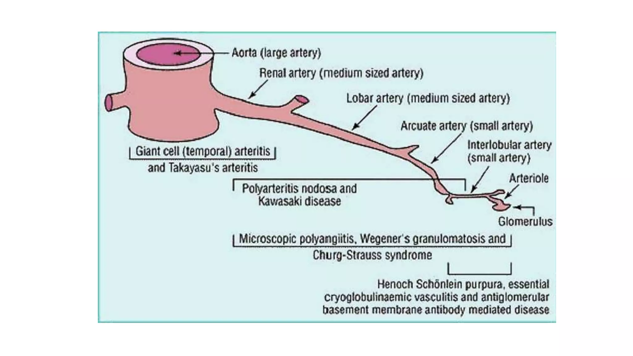 Small vessel vasculitis - Bauer | PPTX