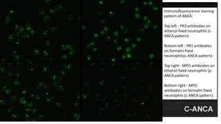 Small vessel vasculitis - Bauer | PPTX