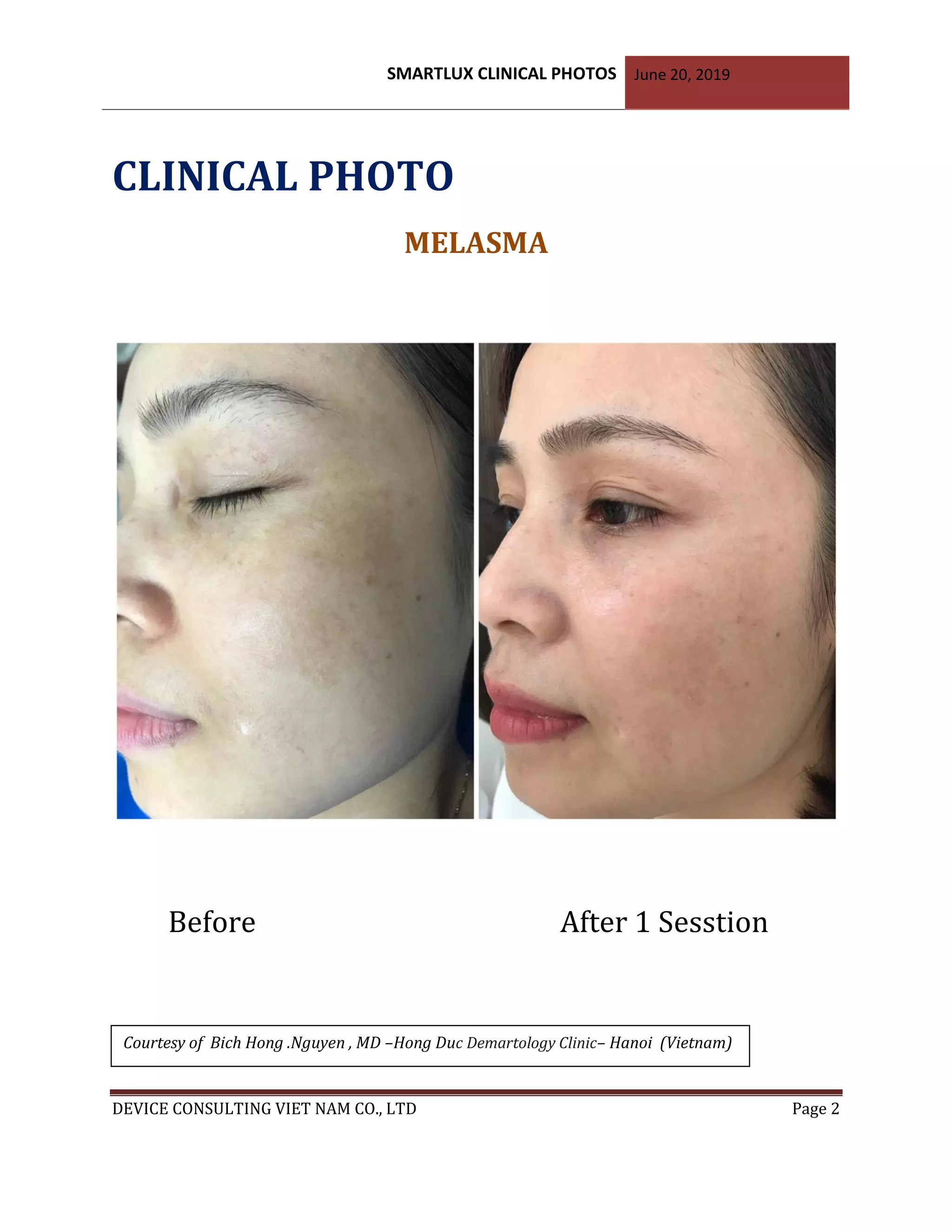 Smartlux Dynamic Therapy Clinical Photos | PDF