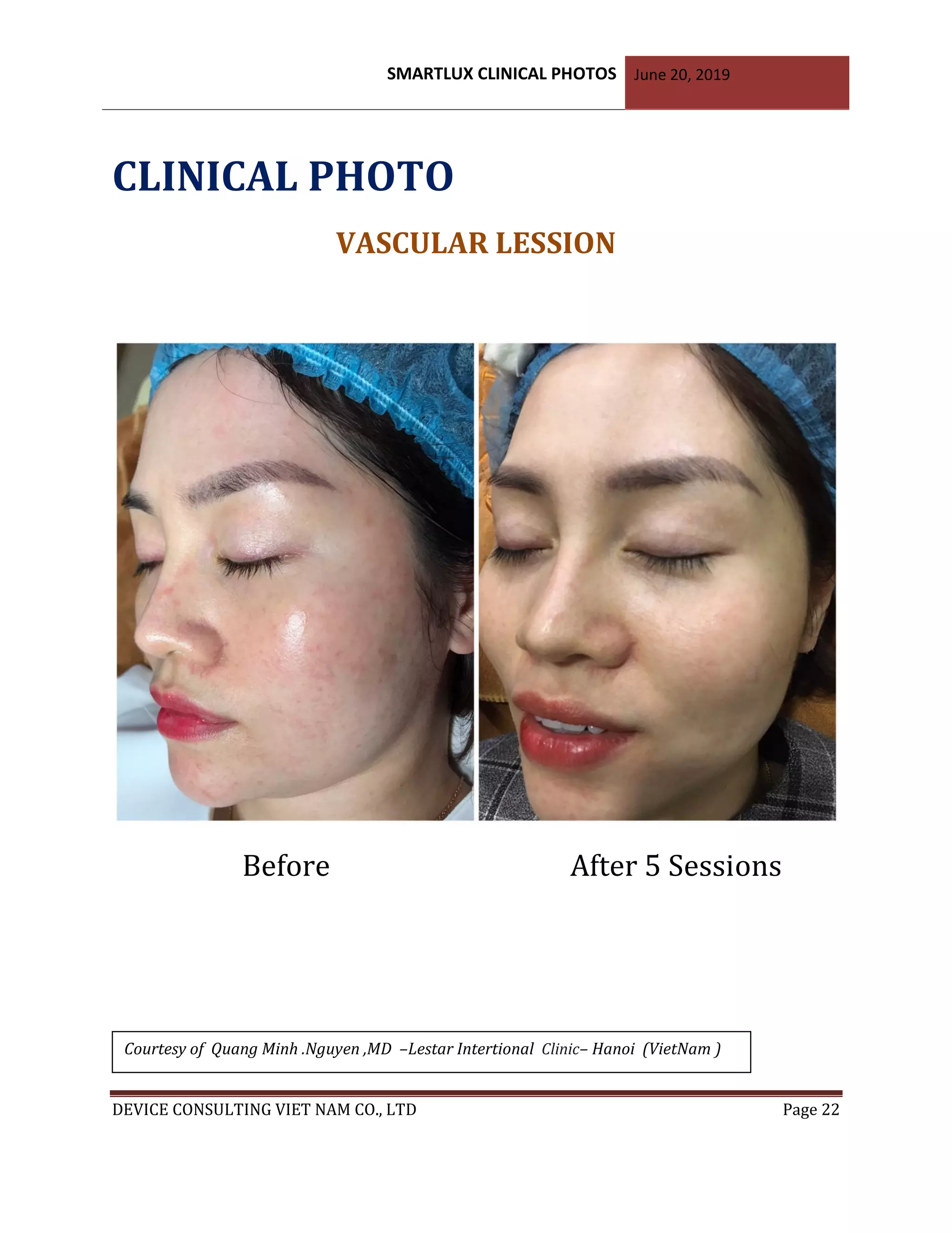 Smartlux Dynamic Therapy Clinical Photos | PDF