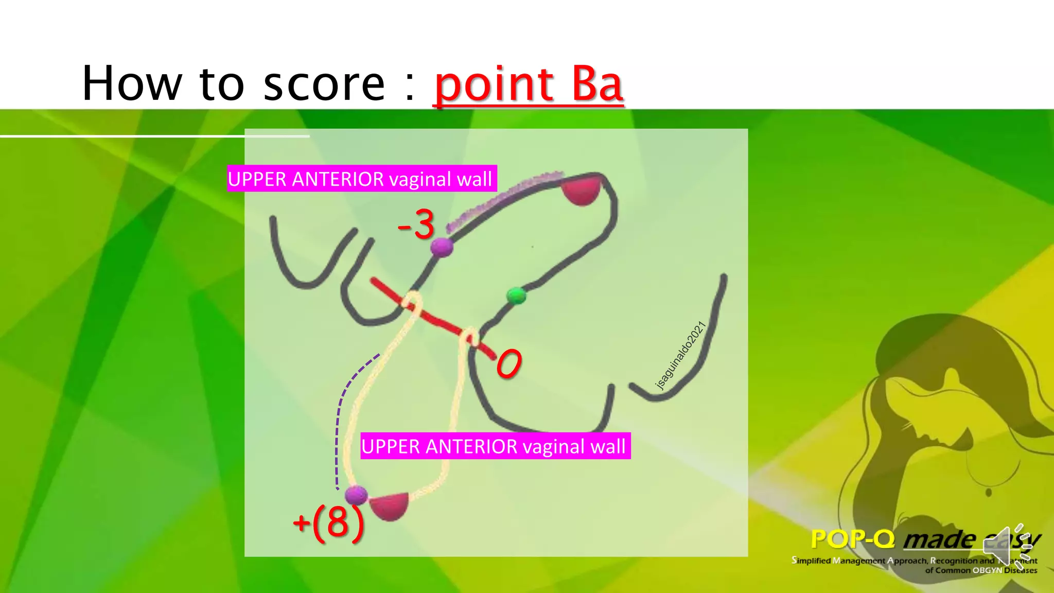 POP-Q made easy | PPSX