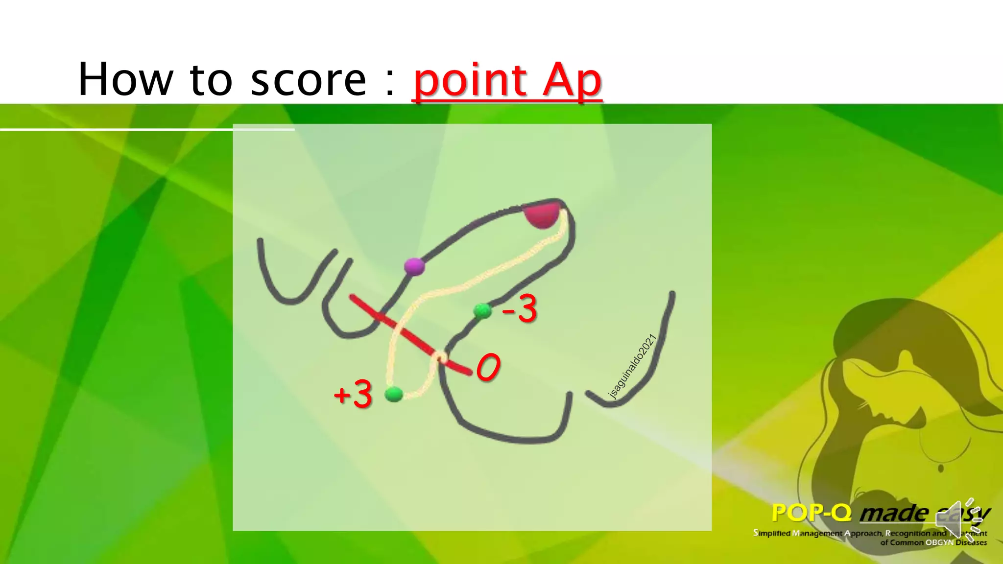 POP-Q made easy | PPSX