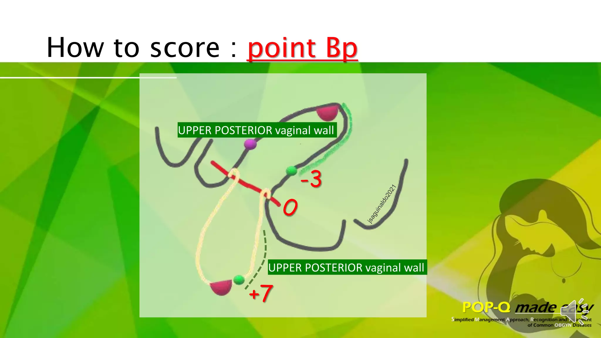 POP-Q made easy | PPSX | Reproductive Health | Diseases and Conditions