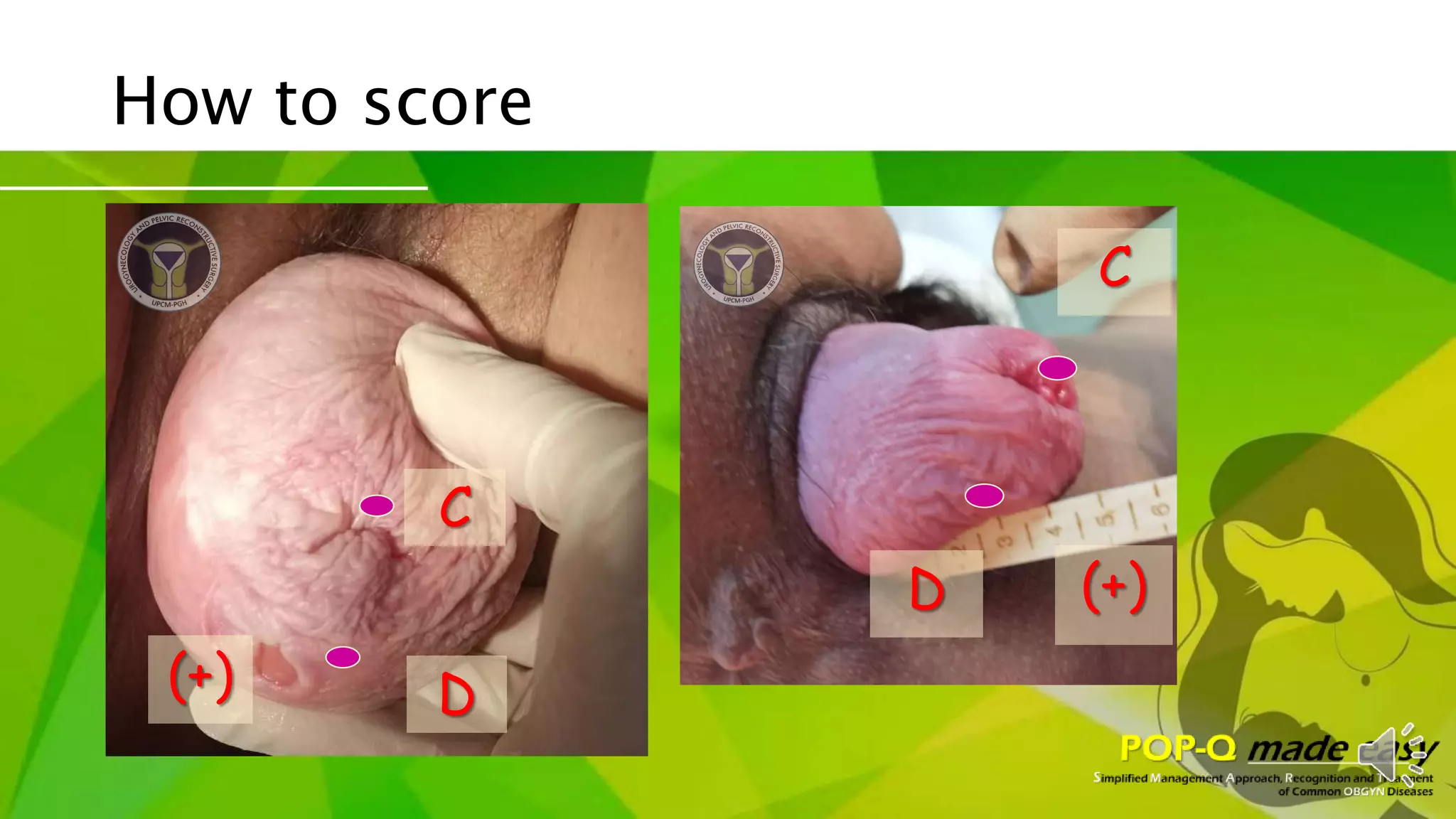 POP-Q made easy | PPSX