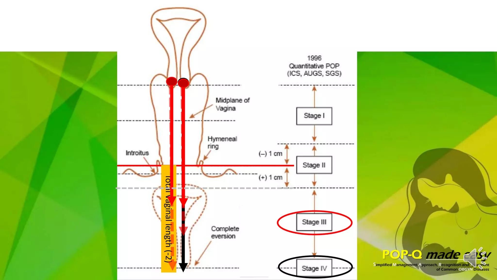 POP-Q made easy | PPSX | Reproductive Health | Diseases and Conditions