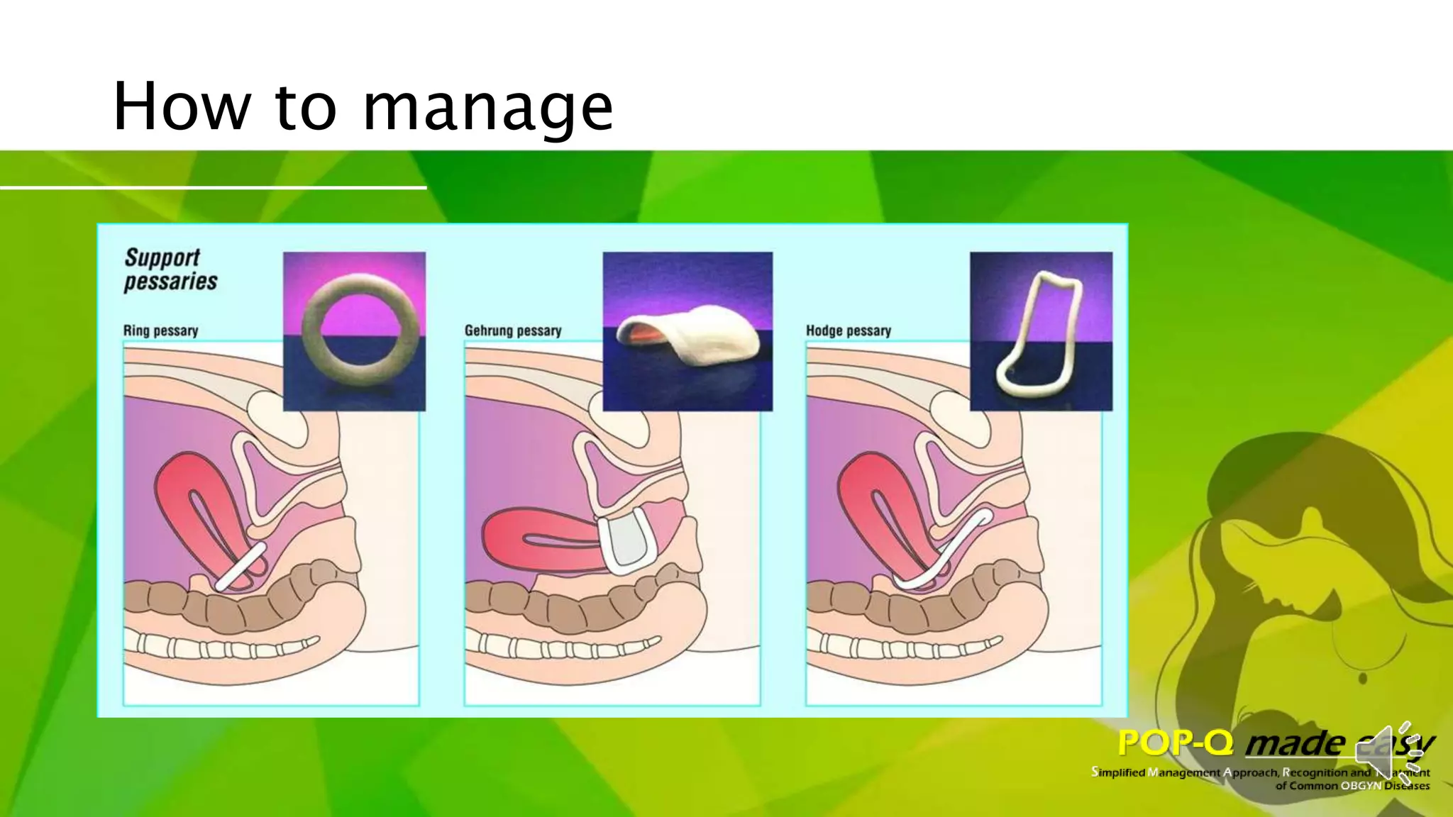 POP-Q made easy | PPSX