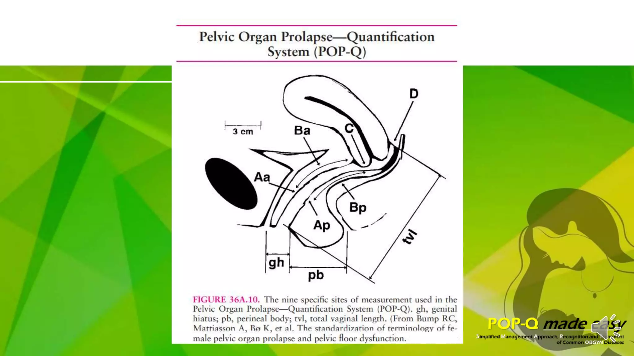 POP-Q made easy | PPSX