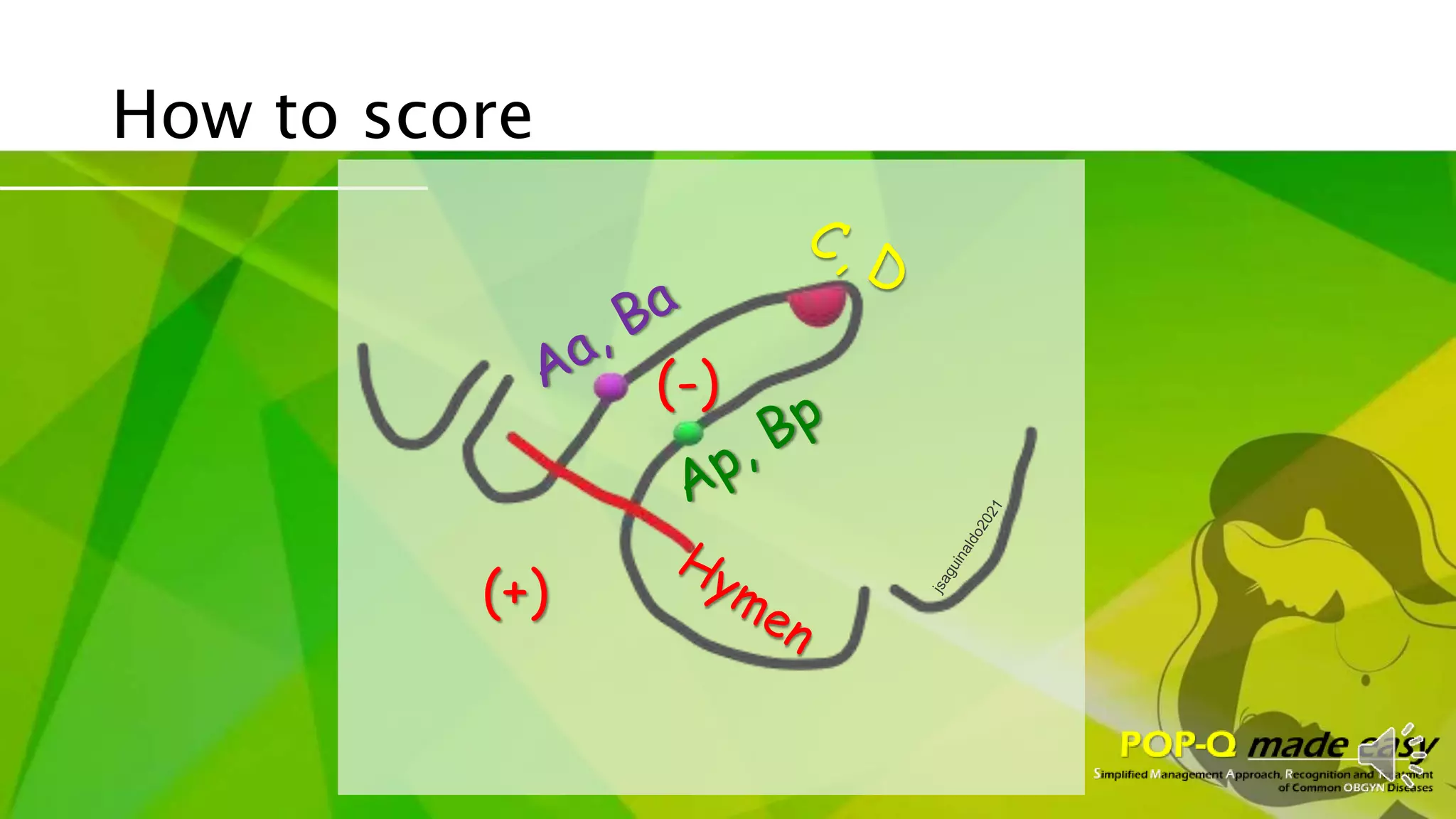 POP-Q made easy | PPSX