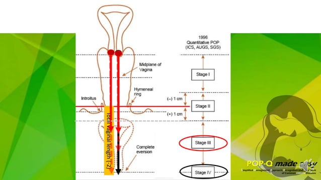 POP-Q made easy | PPSX | Reproductive Health | Diseases and Conditions
