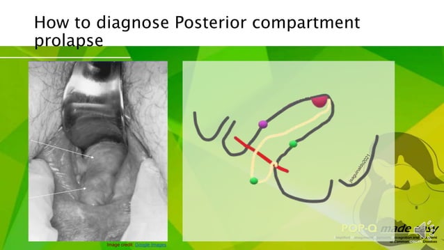 POP-Q made easy | PPSX | Reproductive Health | Diseases and Conditions