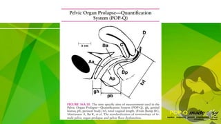 POP-Q made easy | PPSX | Reproductive Health | Diseases and Conditions