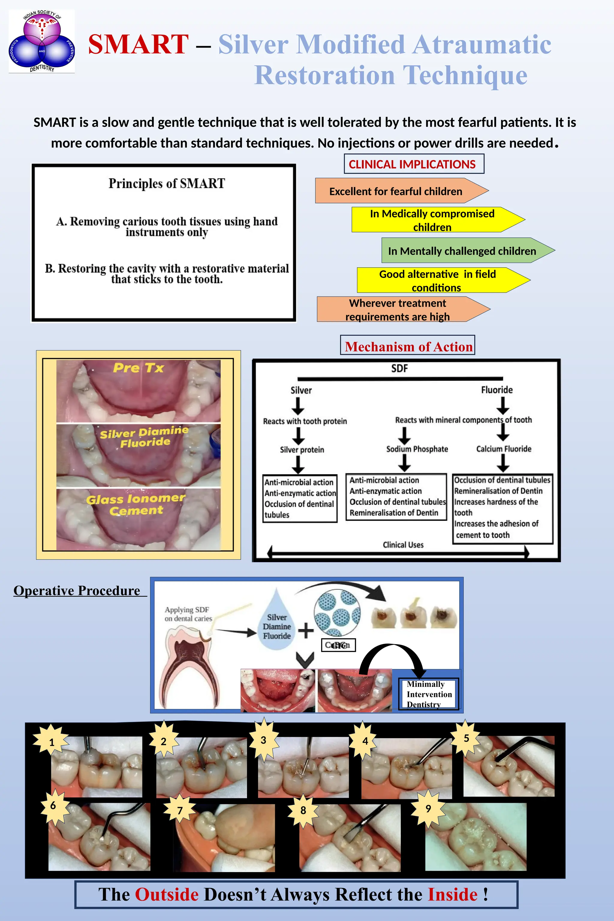 SMART – Silver Modified Atraumatic Restoration (1) (1).pptx
