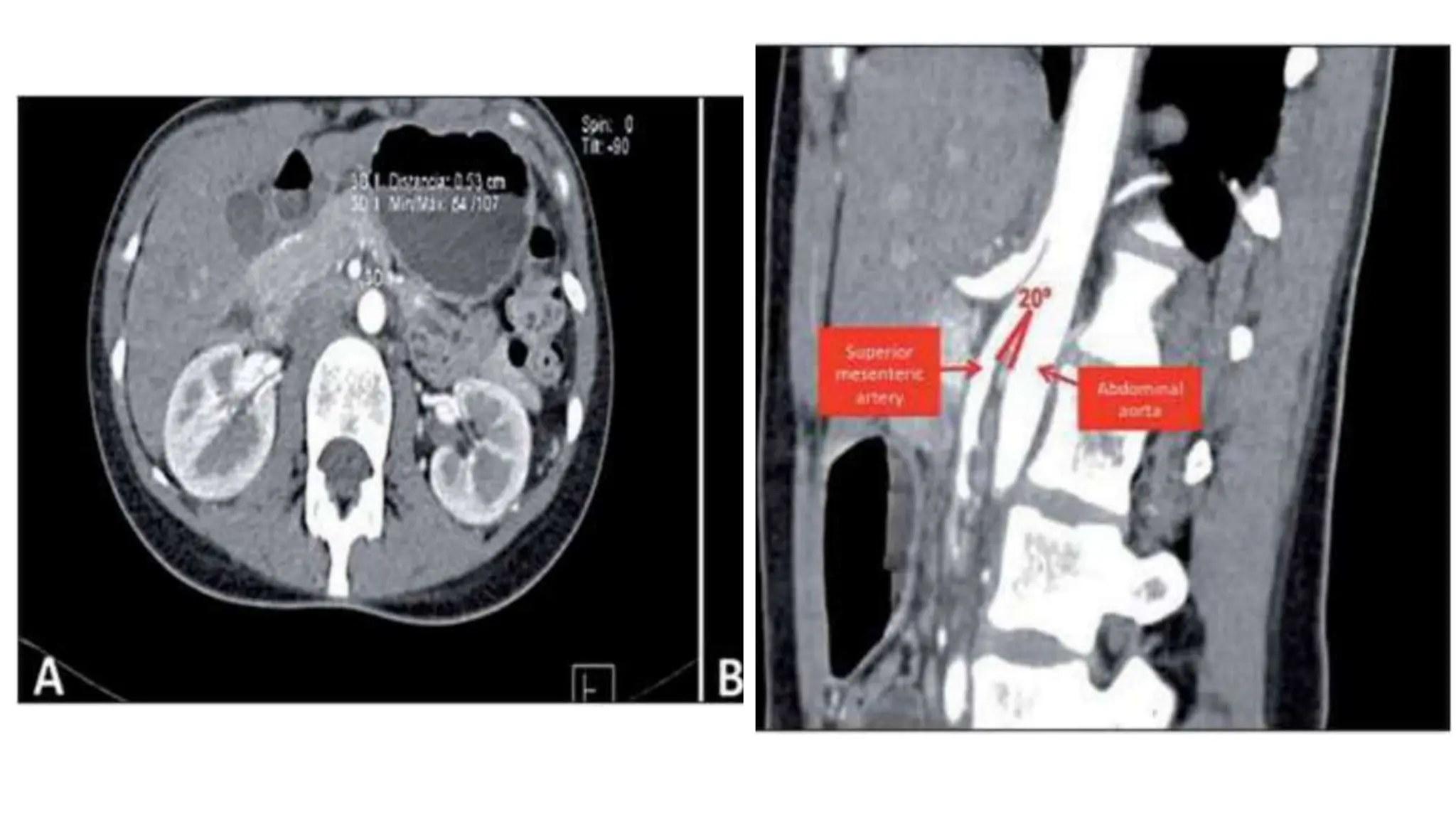 sma syndrome Superior mesenteric artery syndrome | PPTX