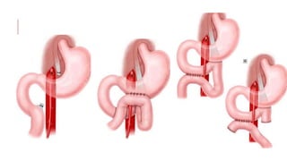 sma syndrome Superior mesenteric artery syndrome | PPTX