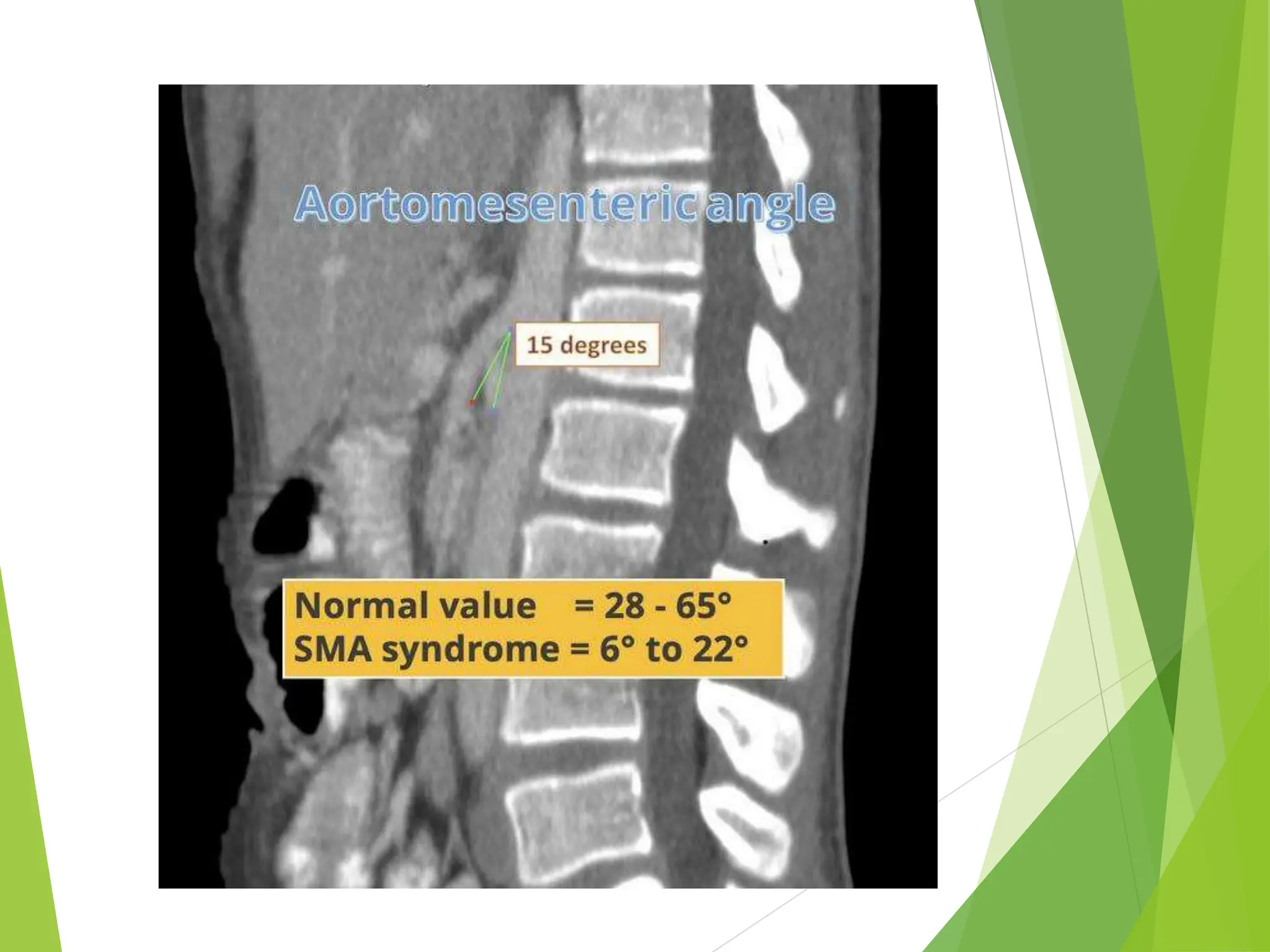 SMA SYNDROME as a surgical point of view.pptx