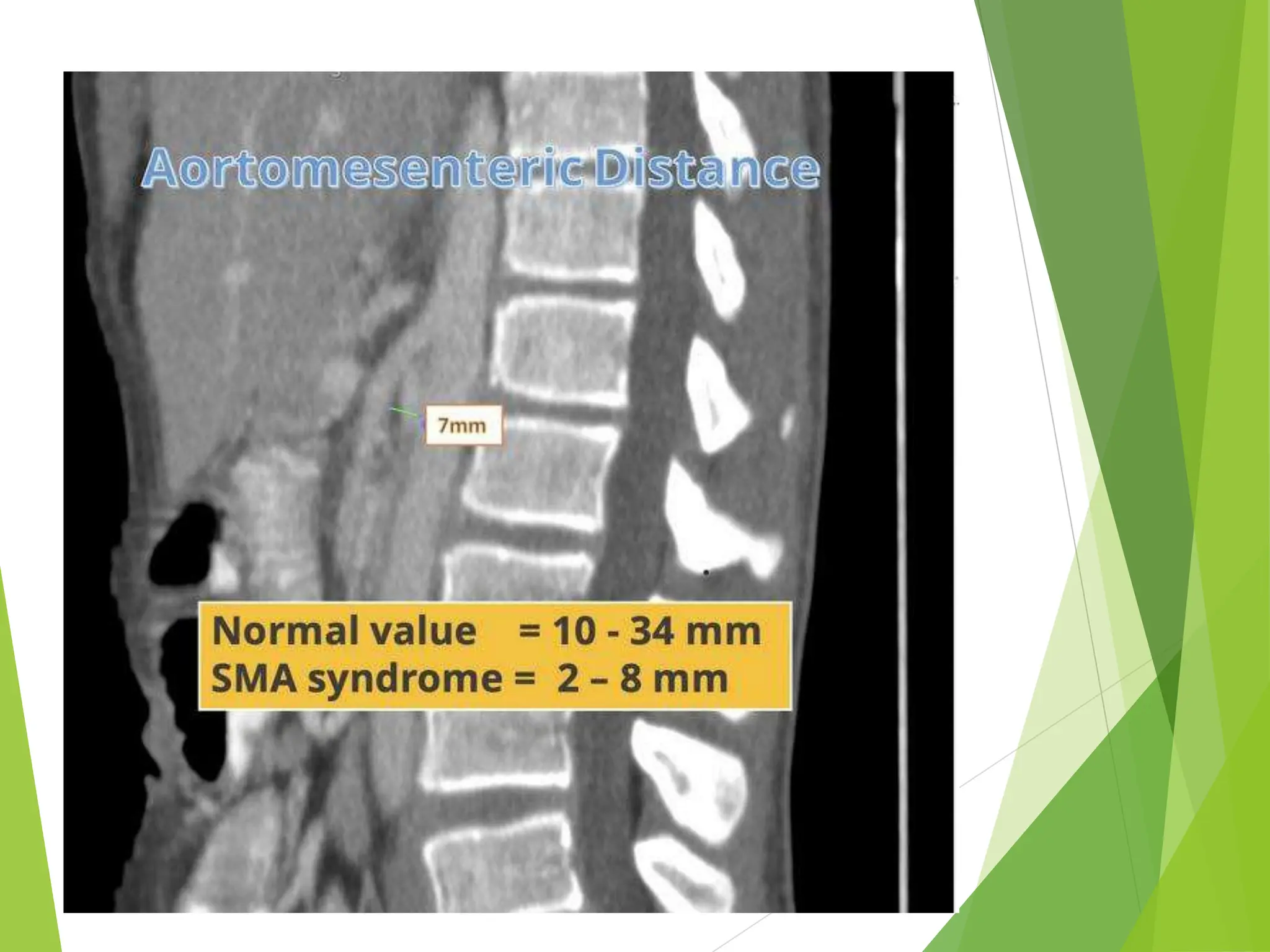 SMA SYNDROME as a surgical point of view.pptx