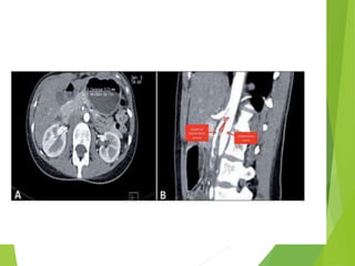 SMA SYNDROME as a surgical point of view.pptx
