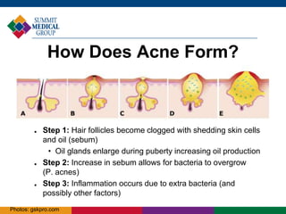 Virtual Lecture: Spot-On Acne Treatment Options - Mital Patel-Cohen, MD ...
