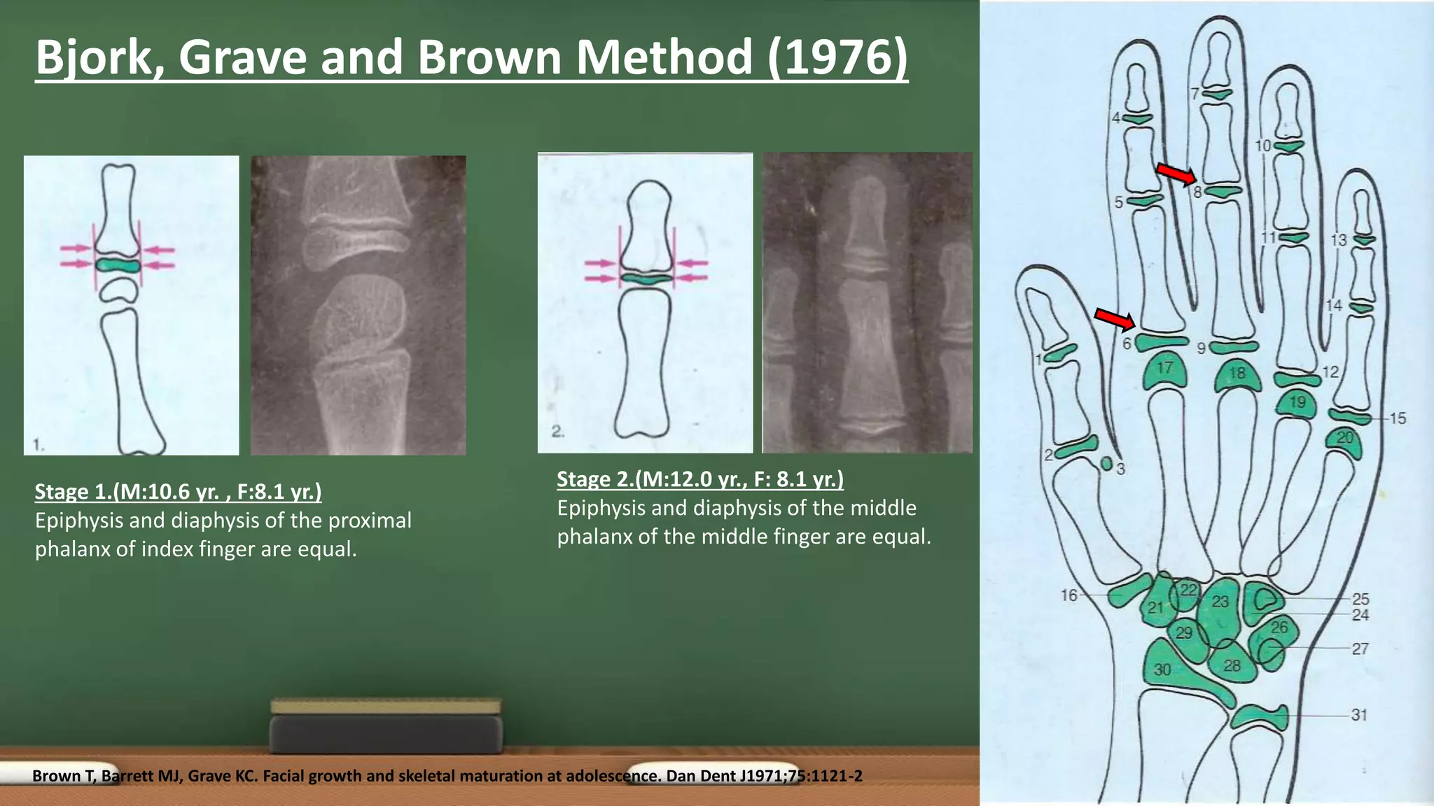 Skeletal Age Assessment and Maturity Indicators | PPTX