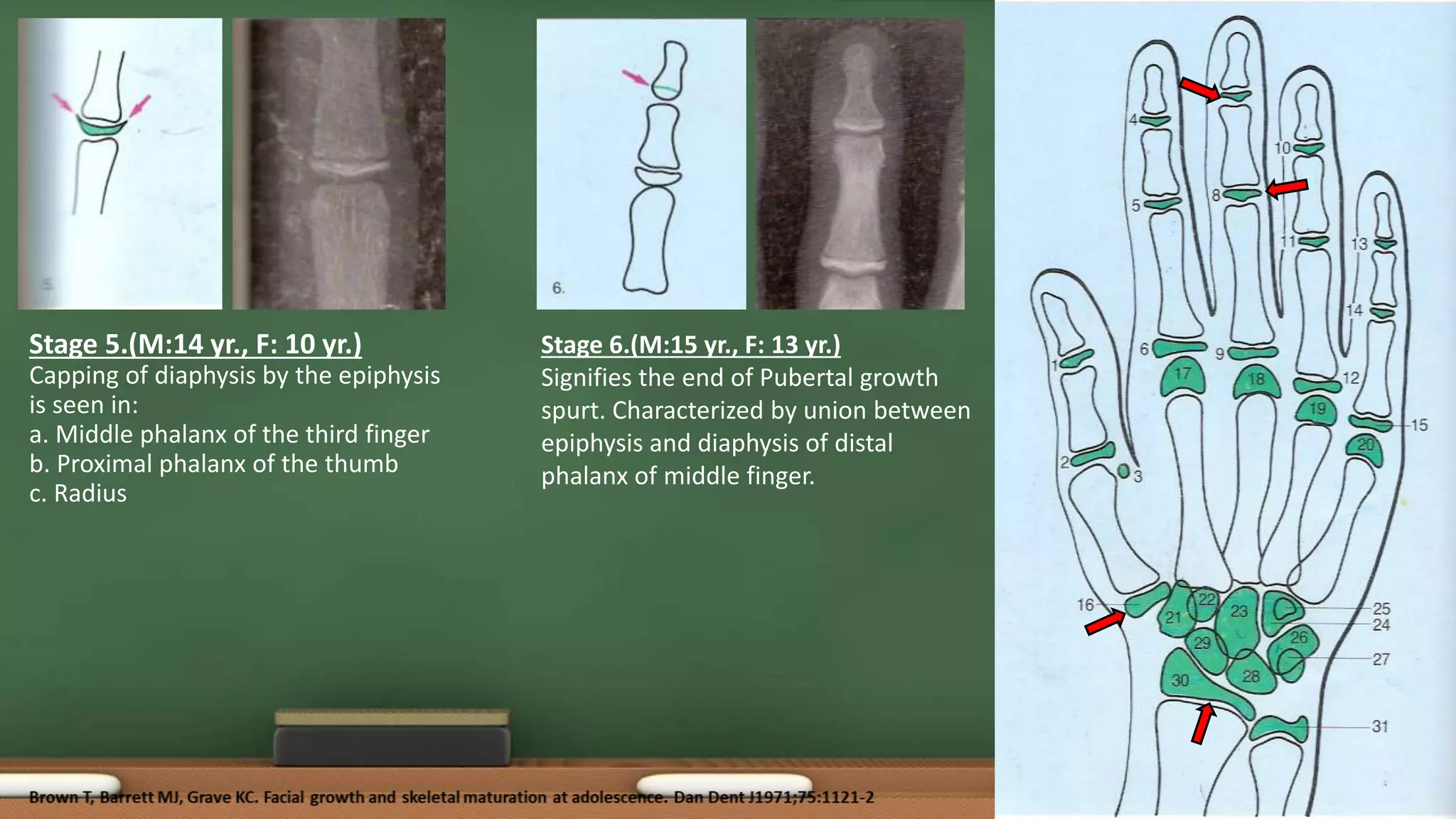 Skeletal Age Assessment and Maturity Indicators | PPTX