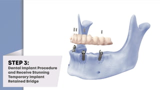 Non-Removable Hybrid Bridge: The Best Alternative to Conventional ...
