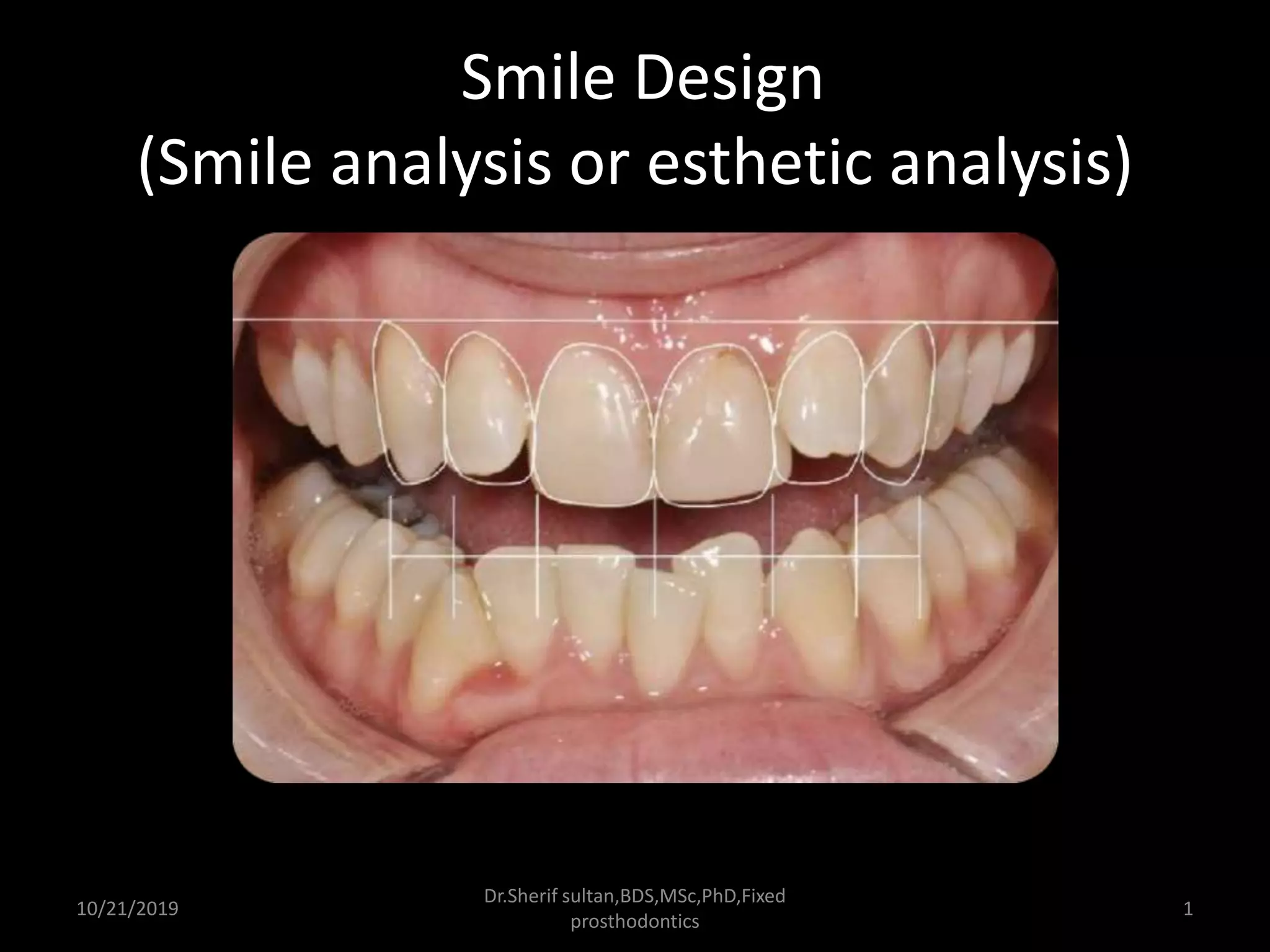 Smile analysis and digital smile design | PPTX