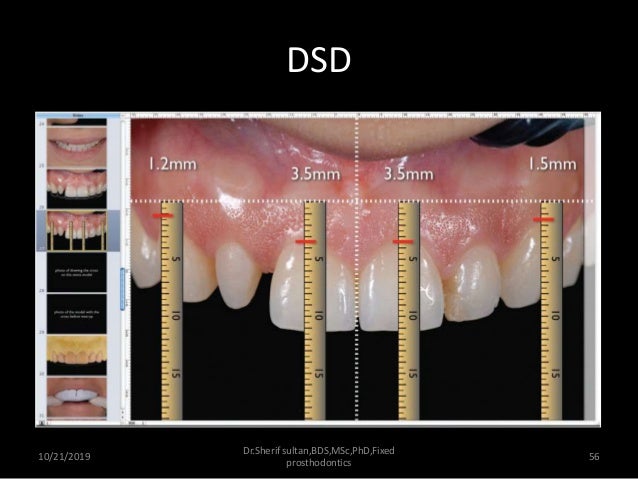 Smile analysis and digital smile design