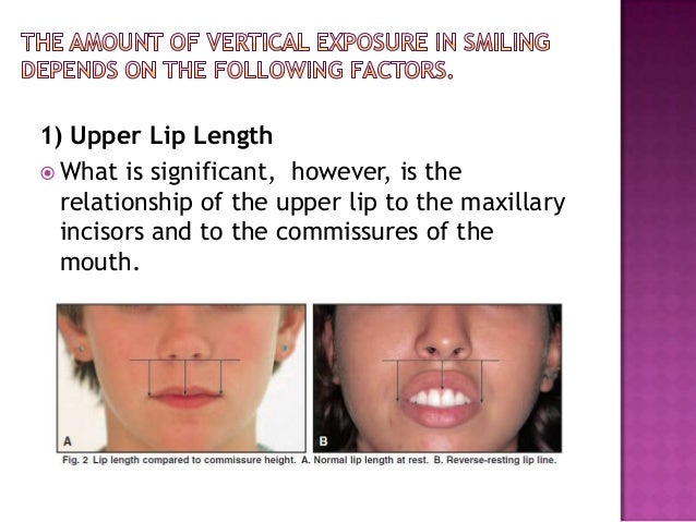 Smile analysis in vertical dimention:- factors to be considered when