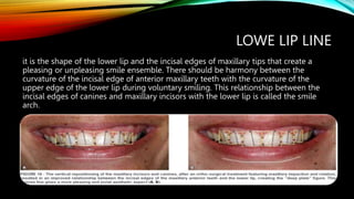 Smile Arc Positioning.pptx