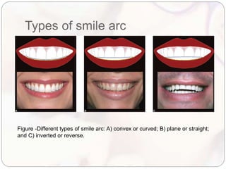 Smile design in orthodontics.pptx