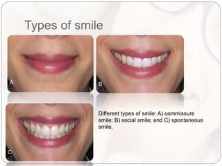 Smile design in orthodontics.pptx