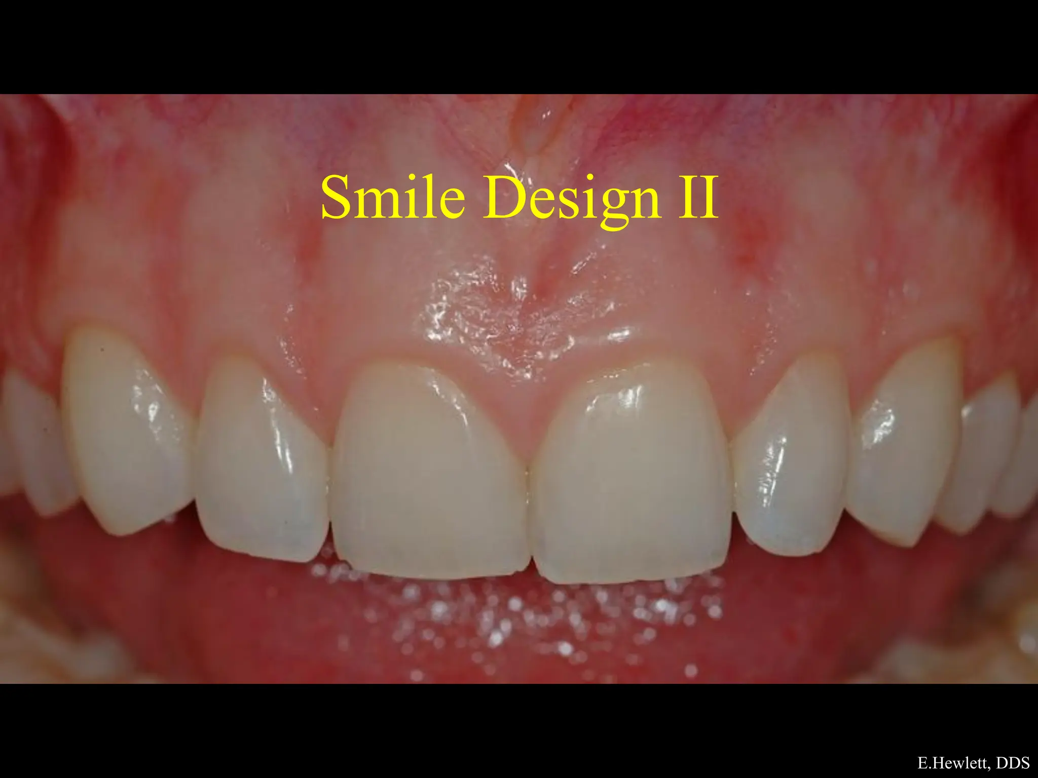 Smile Designs II, things to consider .pdf