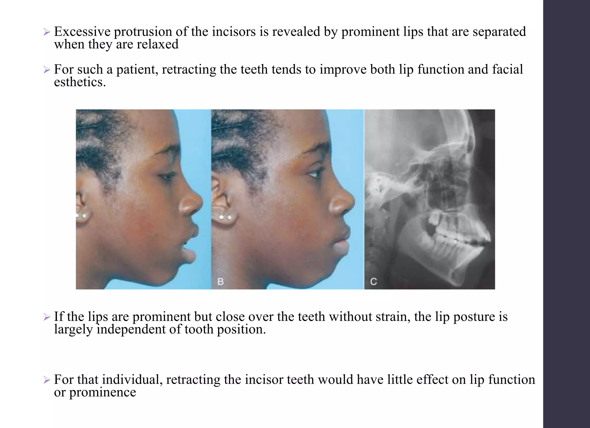 Smile esthetics in orthodontics | PPTX