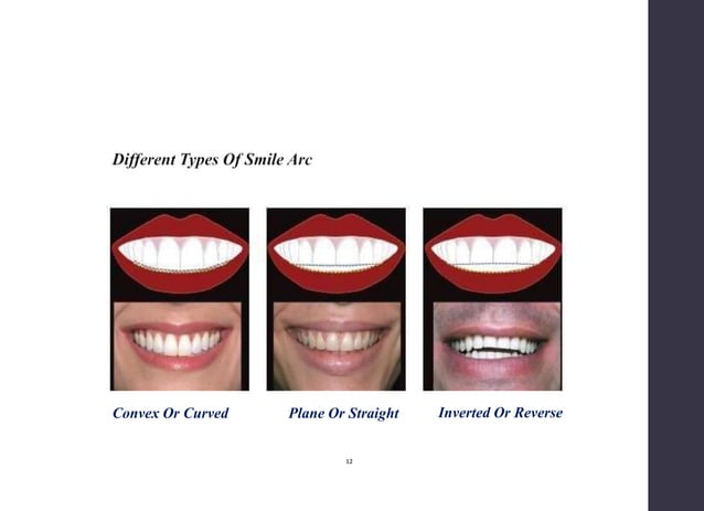 Smile esthetics in orthodontics | PPTX | Dental Health | Diseases and ...