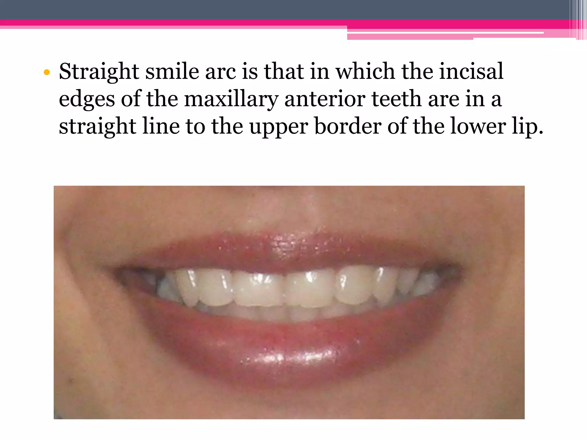 Smile in orthodontics | PPTX