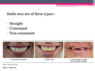 Smile in orthodontics | PPT