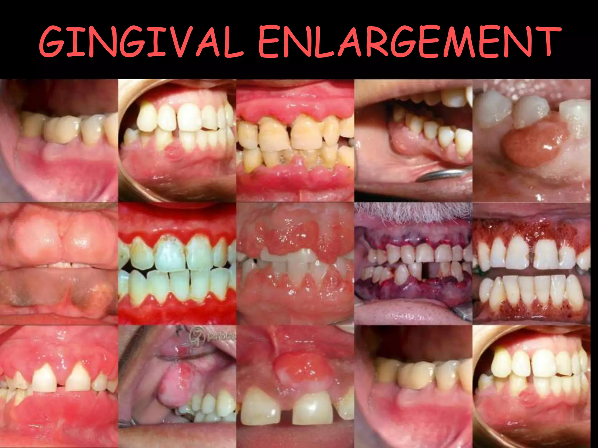 Gingival enlargement | PPT