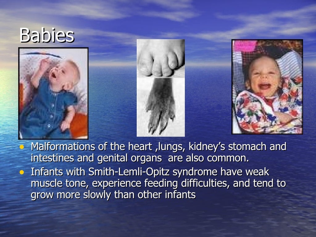 Smith Lemli Opitz Syndrome