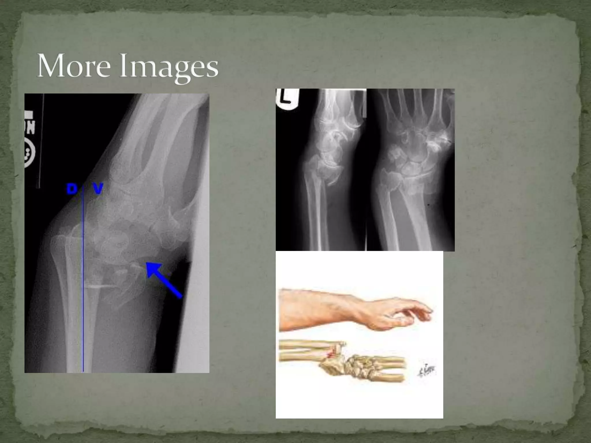 Smith’s fracture | PPTX